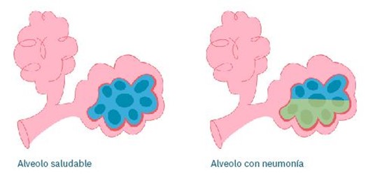 TEMA 2. PATOLOGÍA INFLAMATORIA DEL PULMÓN