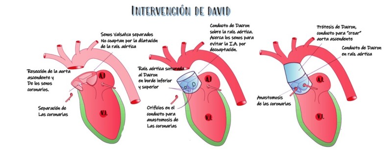 TEMA2. CIRUGÍA EN CIRCULACIÓN EXTRACORPÓREA