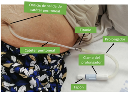 TEMA 2. EL CATÉTER PERITONEAL: PUERTA DE ENTRADA A LA TERAPIA